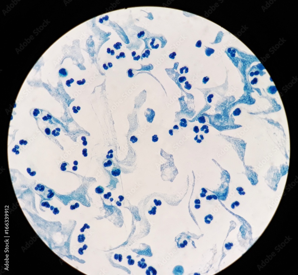 Smear of Acid-Fast bacilli (AFB) stained from sputum specimen with ...