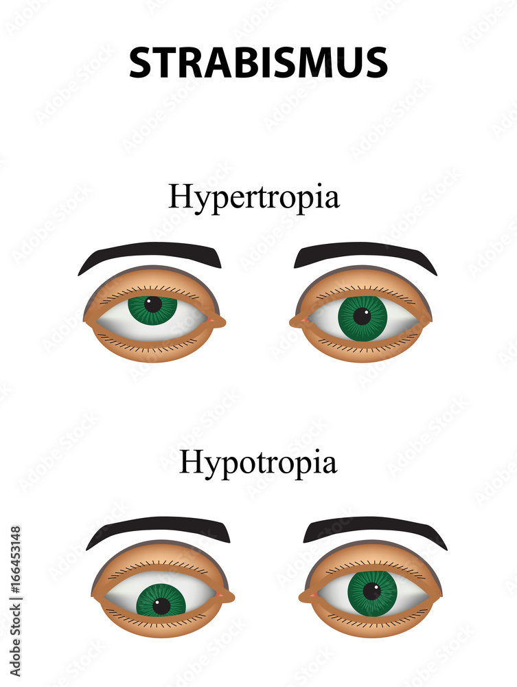 Strabismus. Hypertropia. Hypotropia. Infographics. Vector illustration ...