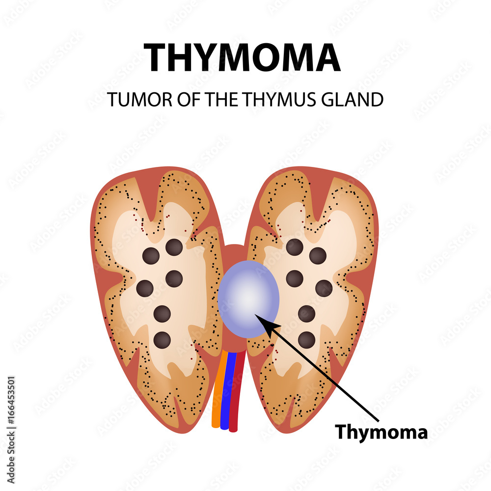 Tumor of the thymus gland. Thymoma. Infographics. Vector illustration ...