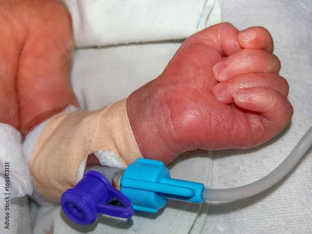 Peripheral intravenous catheter in the vein of newborn baby hand Stock ...