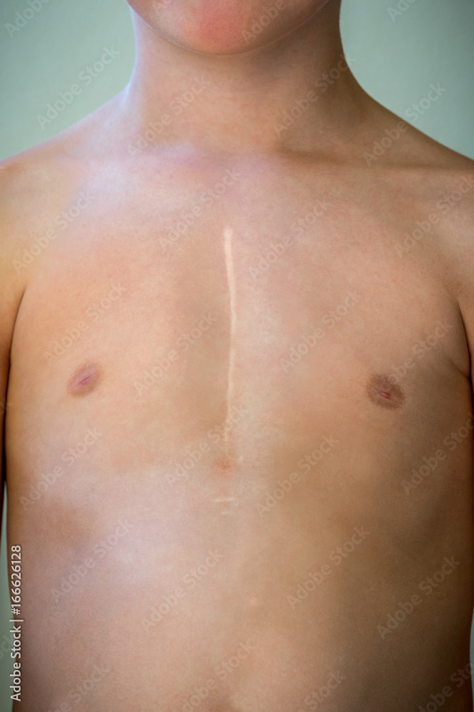 Heart Surgery Scar