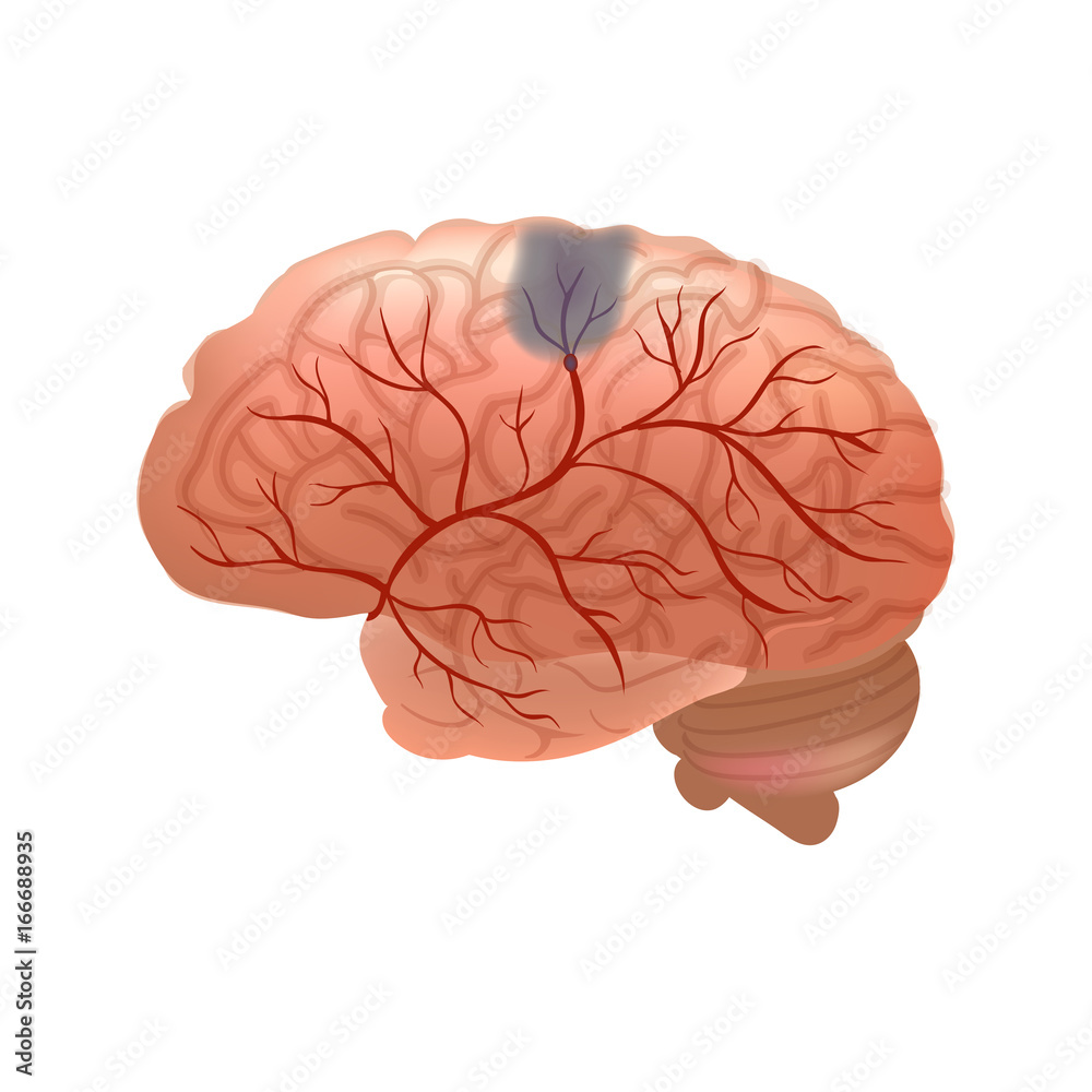 Realistic human sick brain isolated on white background. Stock Vector ...