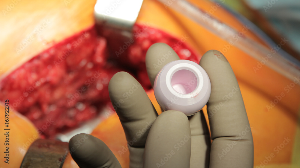 Ceramic hip head in surgeons fingers close up during the hip ...