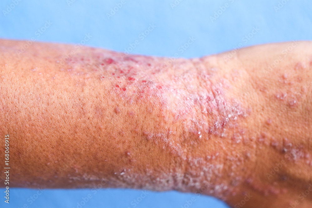 Atopic dermatitis (AD), also known as atopic eczema, is a type of ...