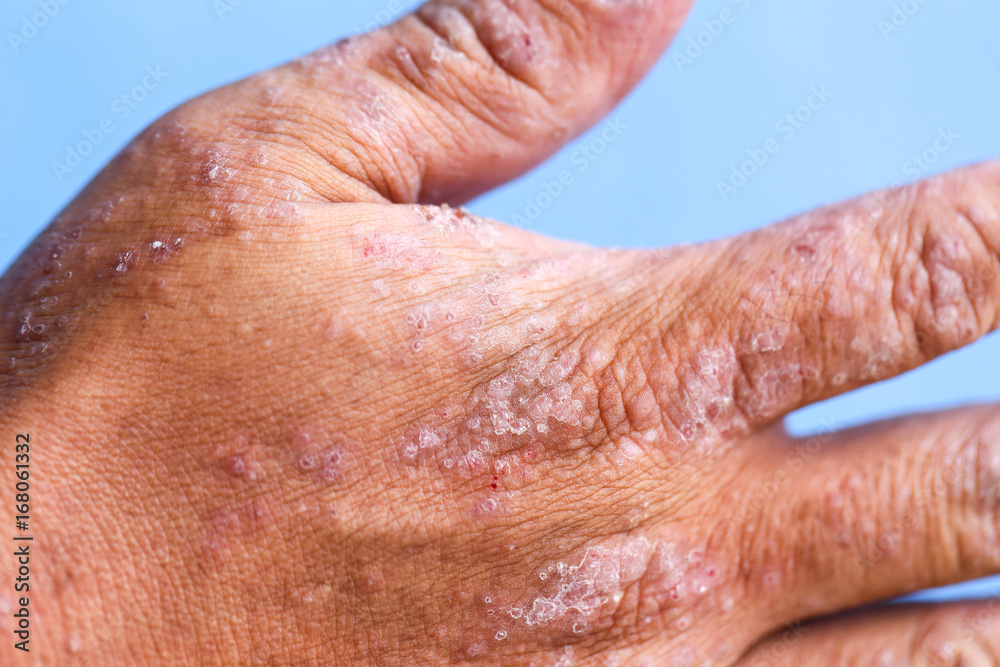 Atopic dermatitis (AD), also known as atopic eczema, is a type of ...