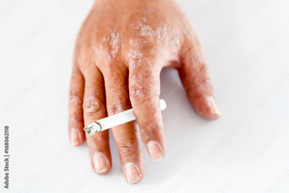 Atopic dermatitis (AD), also known as atopic eczema, is a type of ...