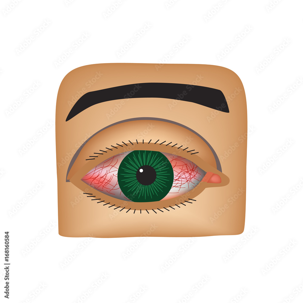 Conjunctivitis. Redness and inflammation of the eye. Vessels in the eye ...