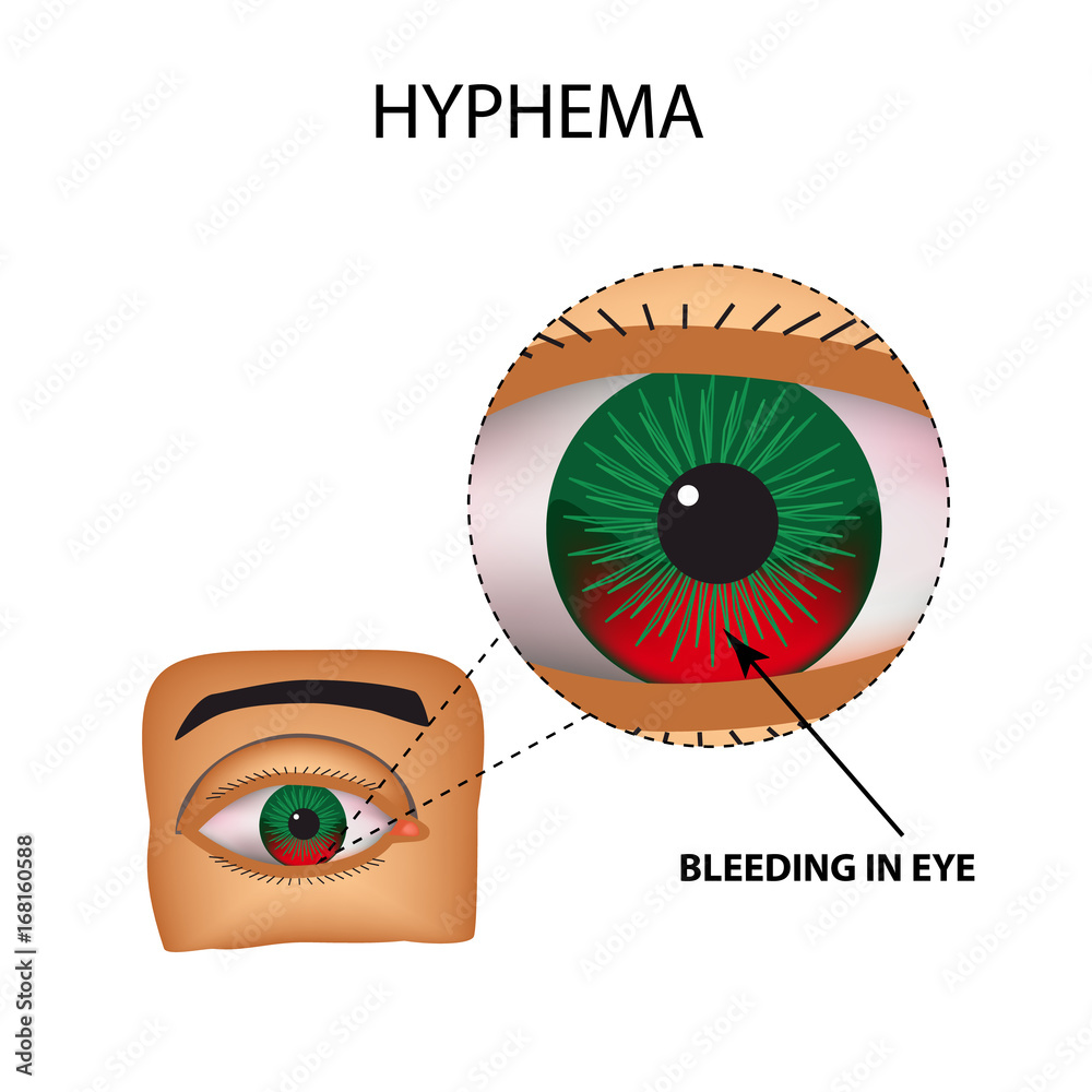 Hyphema. Anterior eye hemorrhage. The structure of the eye ...