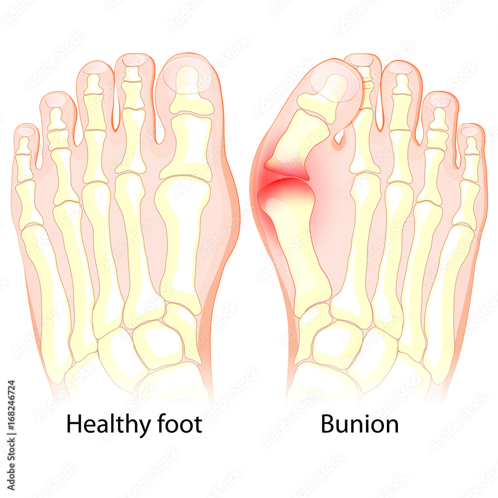 Bunion. Human anatomy. Skeleton vector de Stock | Adobe Stock
