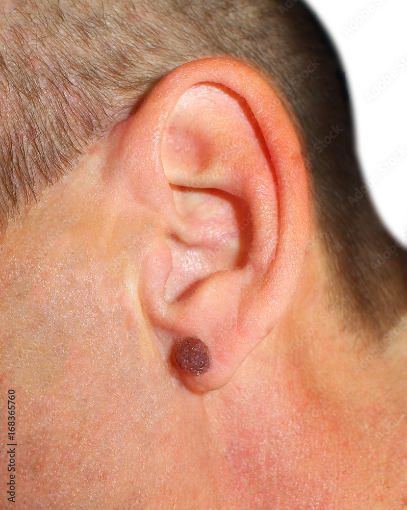 Melanoma Ear