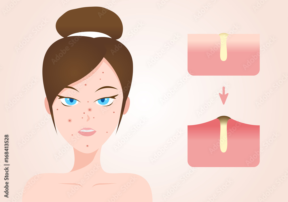 acne and pimple women face with acne stage vector Stock Vector | Adobe ...