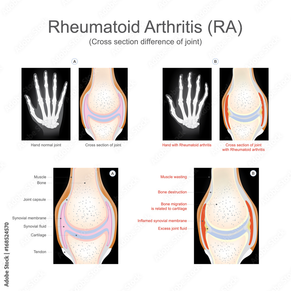 Rheumatoid arthritis is a chronic inflammatory disorder that can affect ...