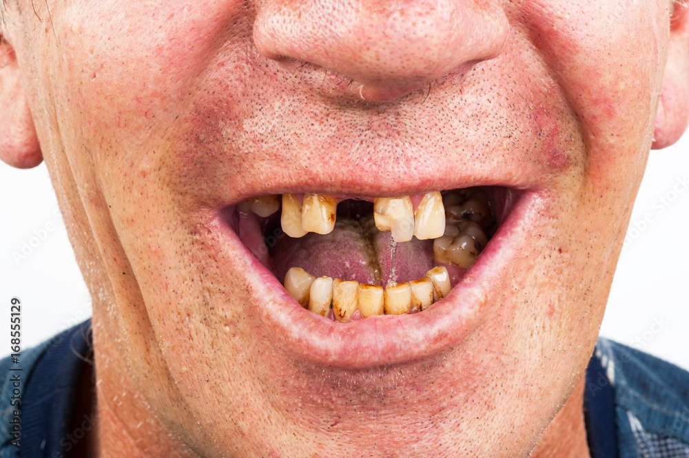 Bad teeth, smoker Stock Photo | Adobe Stock