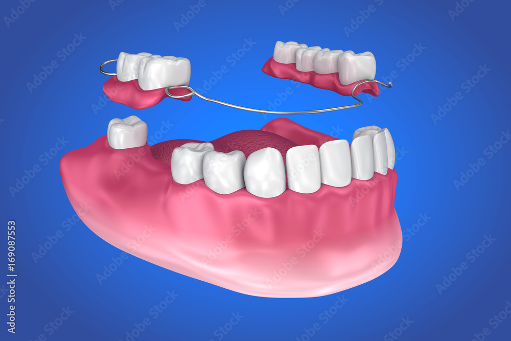 Removable partial denture. Medically accurate 3D illustration Stock ...