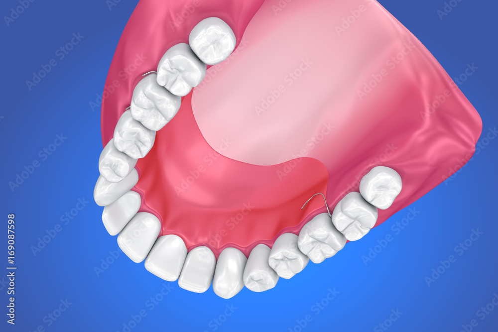 Single Missing Tooth - Removable partial denture . 3D illustration ...