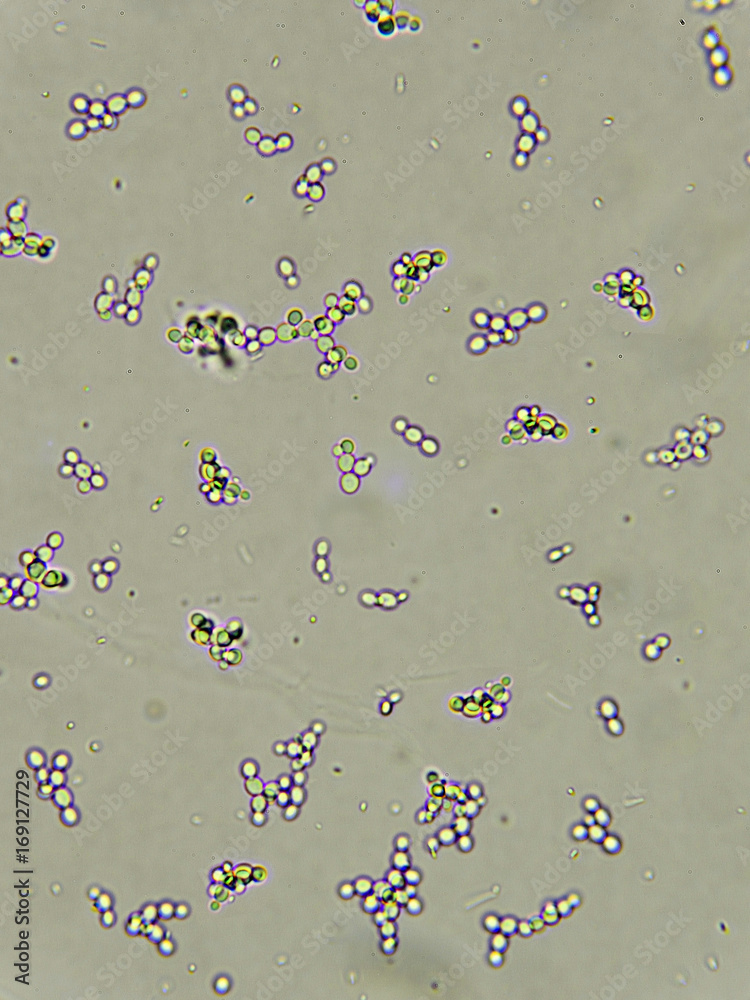 Budding yeast cells in patient urine (urinary tract infections ...