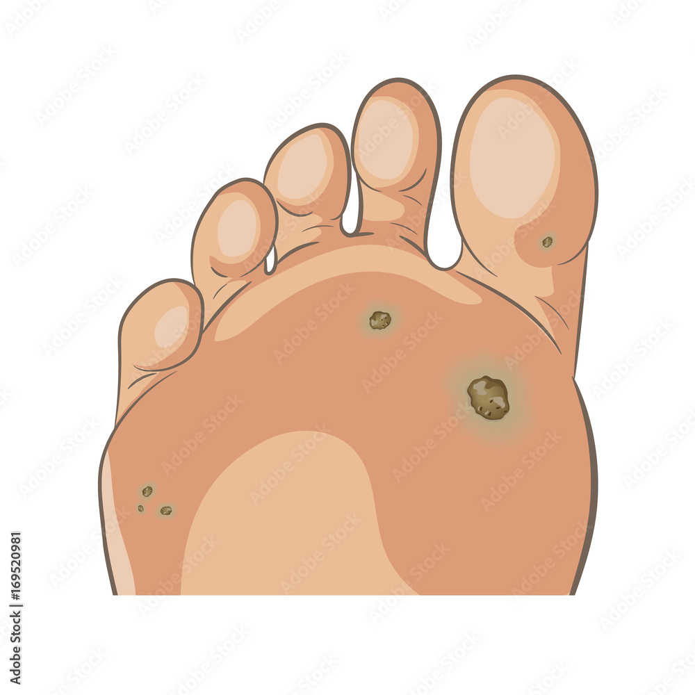 Foot wart. Foot bottom pathology: verruca, wart, papilloma virus. Many ...