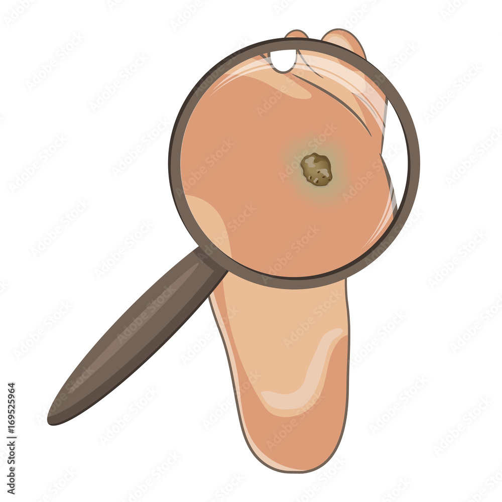 Foot wart magnified with glass. Foot bottom pathology: verruca, wart ...