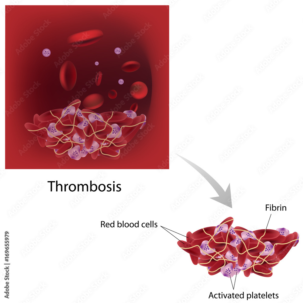 Structure of a thrombosis Stock Illustration | Adobe Stock