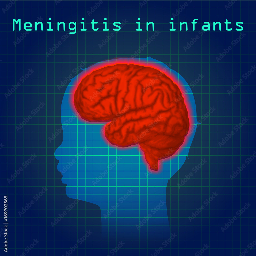 Meningitis in infants. Vector medical illustration. Kid, baby ...