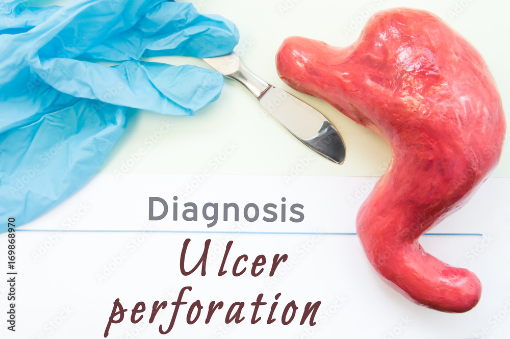 Diagnosis of Ulcer Perforation. Figure stomach, scalpel and surgical ...
