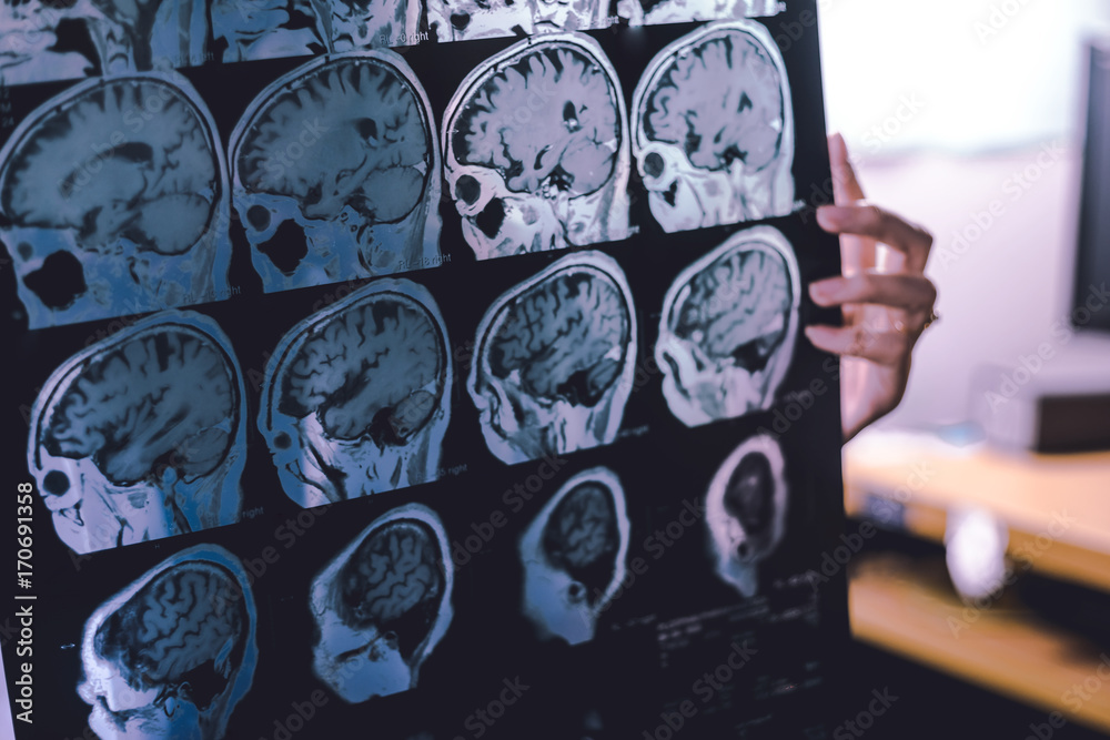 frontal lobe atrophy on MRI film probably Frontotemporal Dementia Stock Photo | Adobe Stock