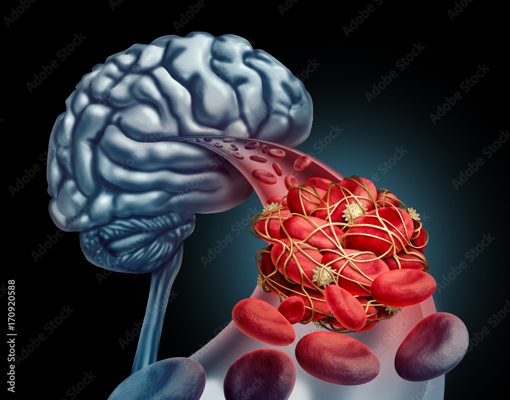 Blood Clot Brain Stock Illustration | Adobe Stock