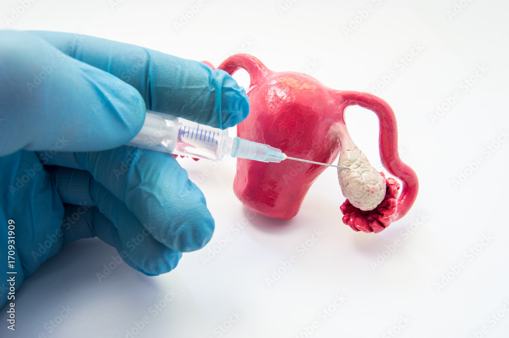 Puncture procedure for egg production, treatment or ovarian stimulation ...