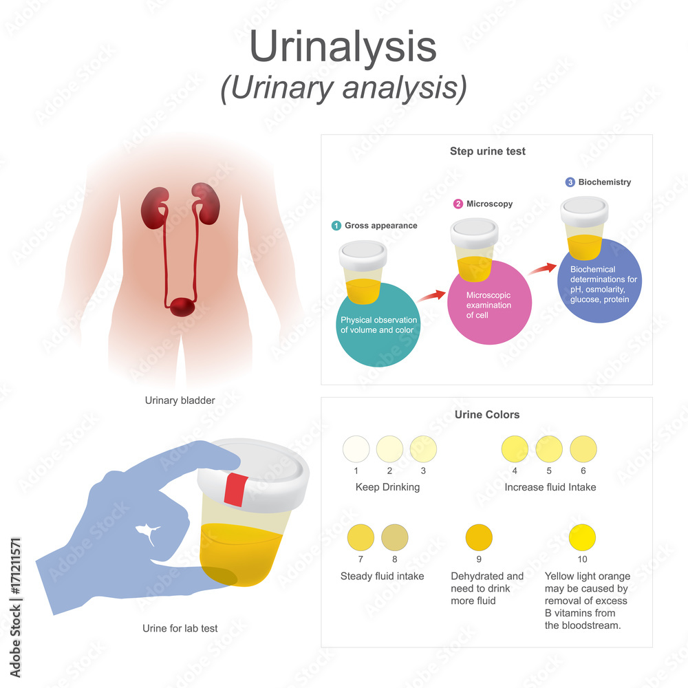 Urinalysis Results Urinary
