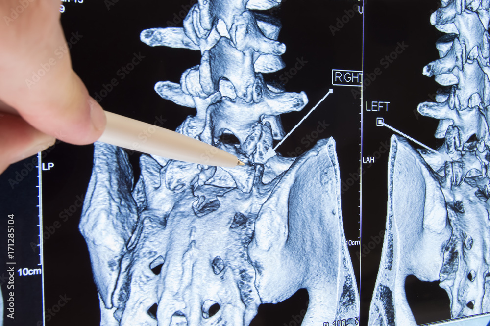 Scan of lumbosacral spine. Doctor pointed on area of lumbar, where ...