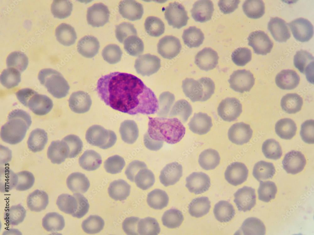 Monocyte cell and malaria parasite in blood smear Stock Photo | Adobe Stock