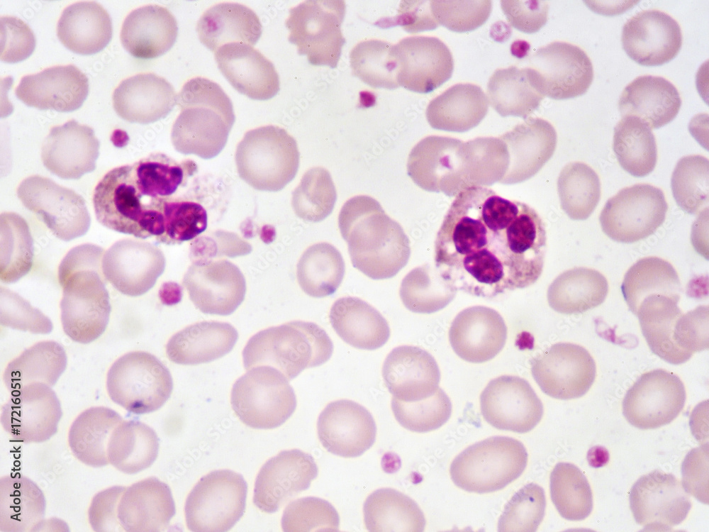 Neutrophil cell (white blood cell) in blood smear, analyze by ...