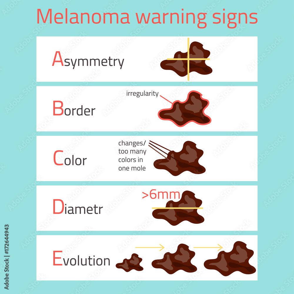 Melanoma warning signs ABCDE. Infographic disease. Vector illustration ...