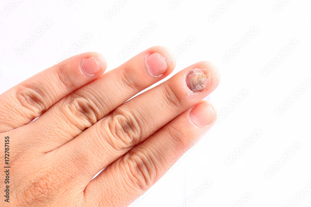 Fungus Infection on Nails Hand, Finger with onychomycosis, Fungal ...