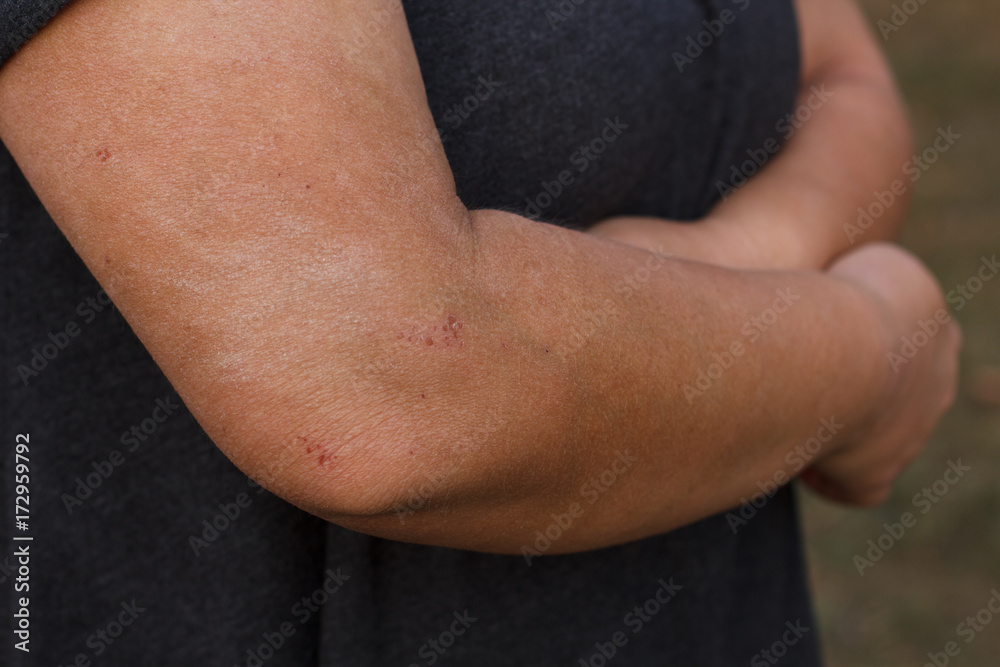 psoriasis on an elbow showing redness and dry patches.Eczema and other ...