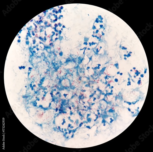 Smear of Acid-Fast bacilli (AFB) stained from human body fluid specimen ...