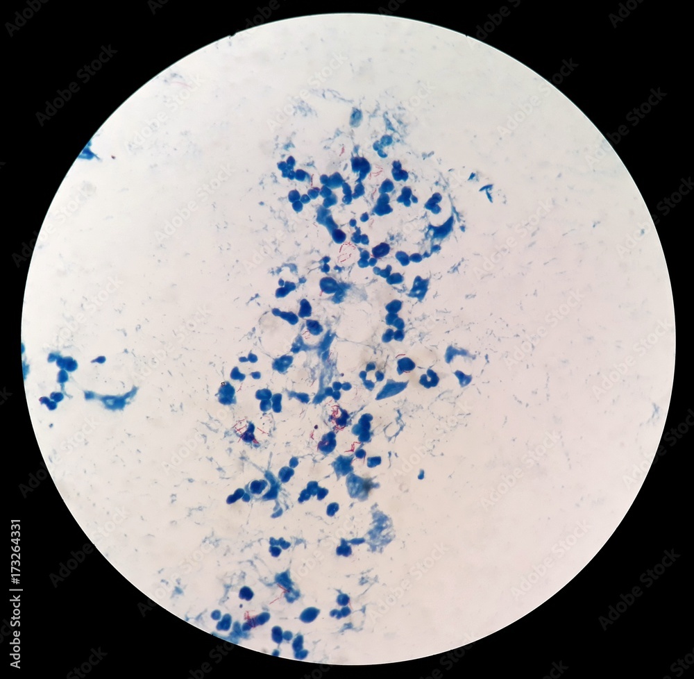 Smear of Acid-Fast bacilli (AFB) stained from human body fluid specimen ...
