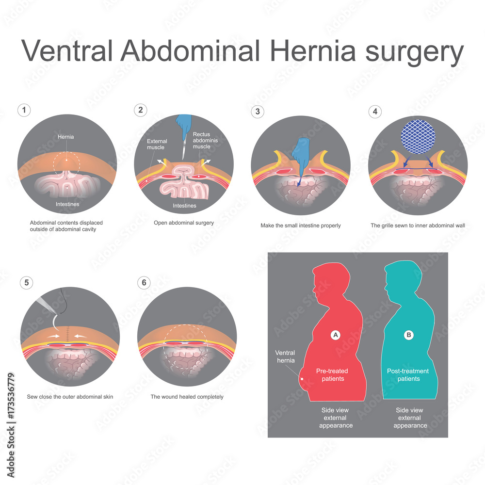 Ventral hernia is a bulge of tissues through an opening of weakness ...