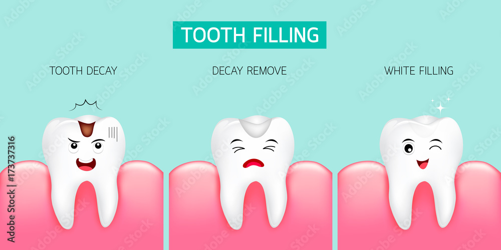 Step of tooth filling. Tooth decay, decay remove and white filling ...