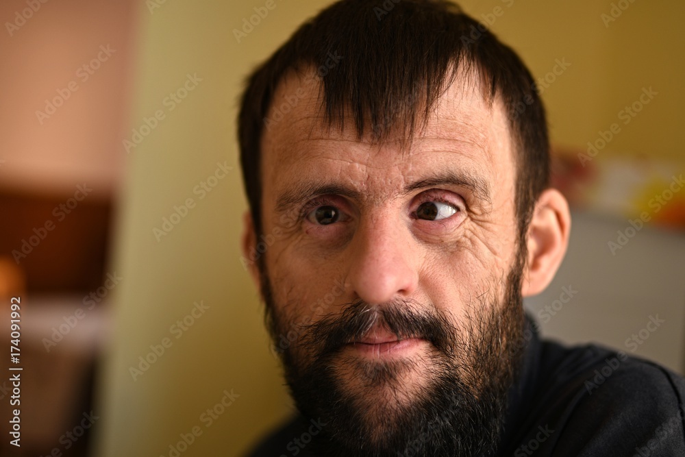 homme trisomique Photos | Adobe Stock