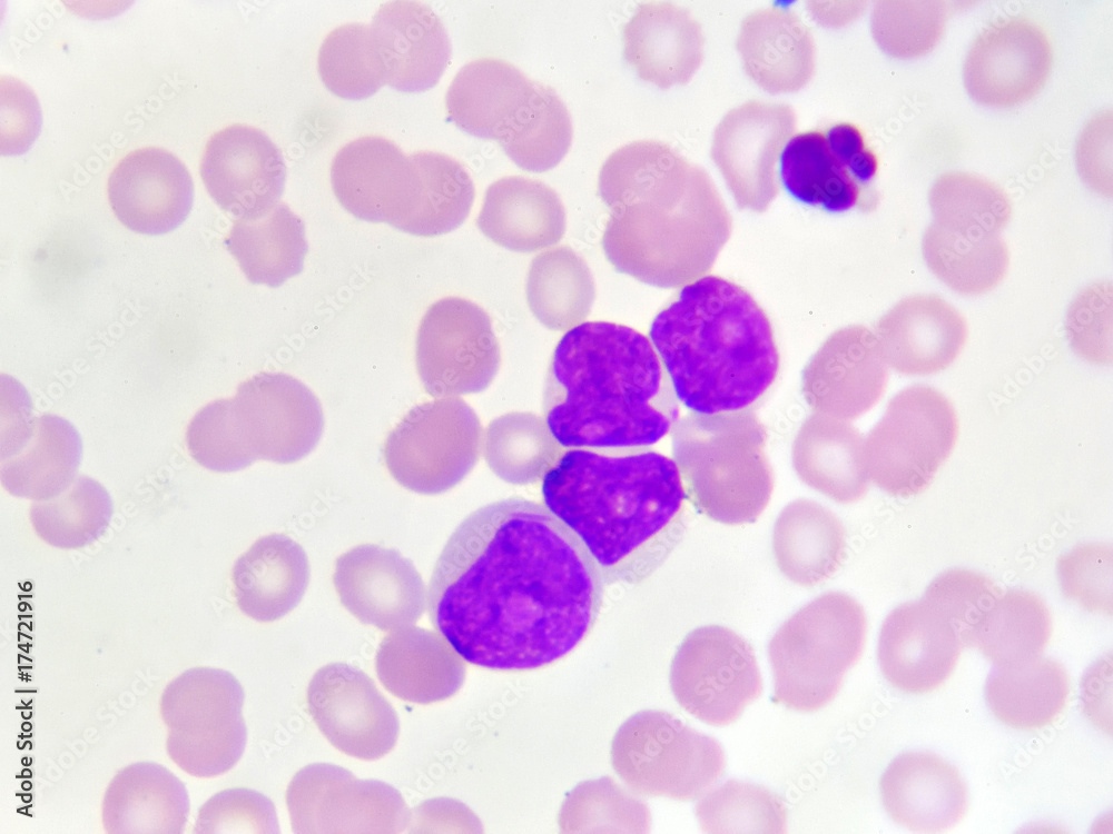 Leukemia Under Microscope