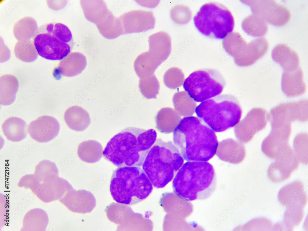 Blood picture of acute myeloid leukemia (AML), analyze by microscope ...