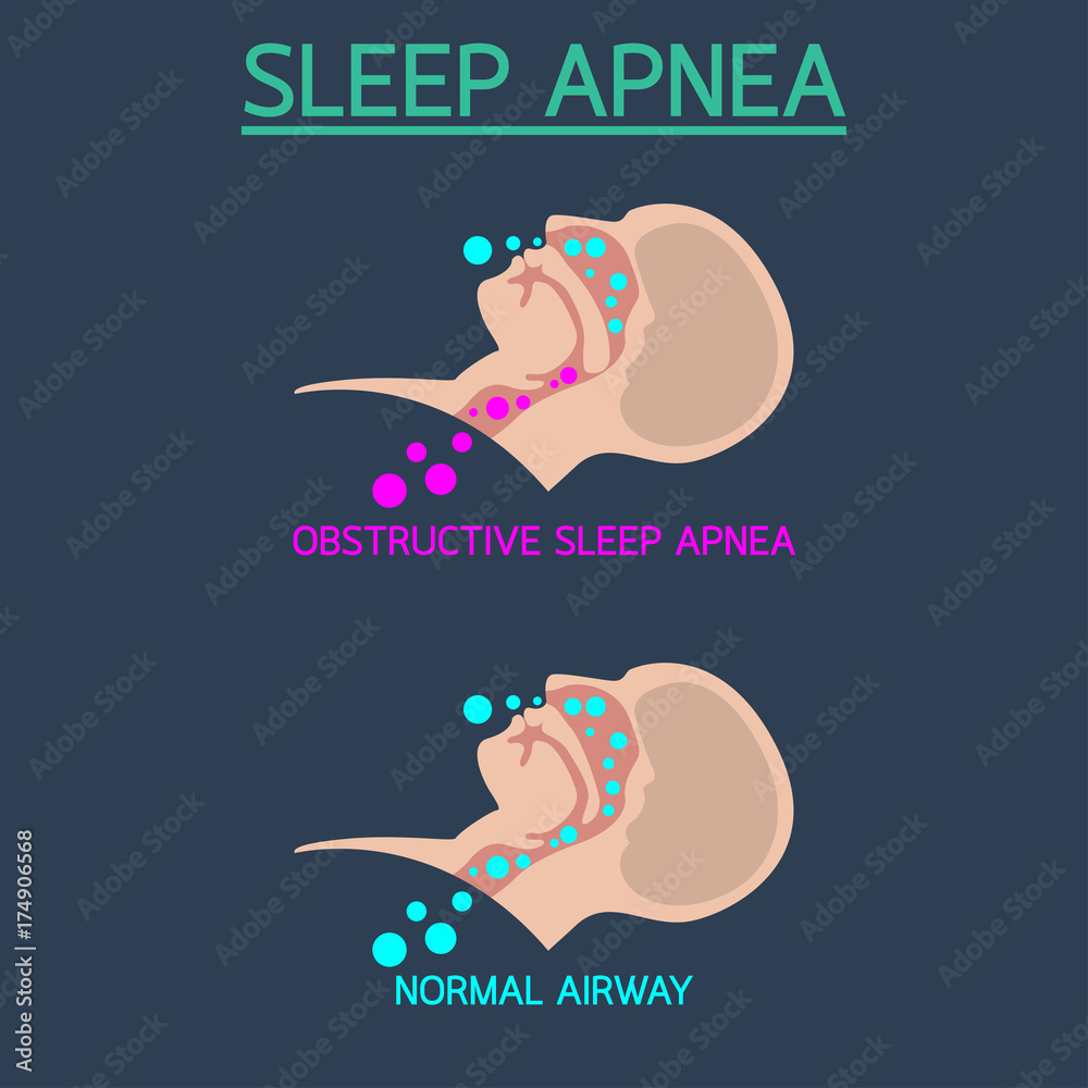 Sleep Apnea vector icon illustration Stock Vector | Adobe Stock
