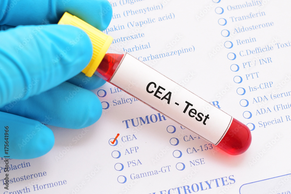 Blood sample for CEA (Carcinoembryonic antigen) test, diagnosis for ...