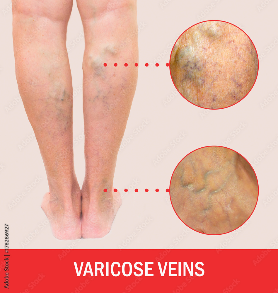 Painful varicose veins,,spider veins, varices on a severely affected ...