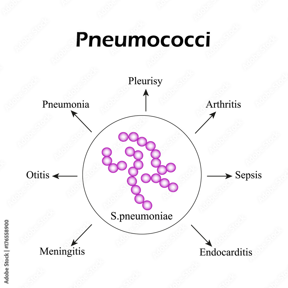 Pneumococci. Pneumococcal diseases. Infographics. Vector illustration ...