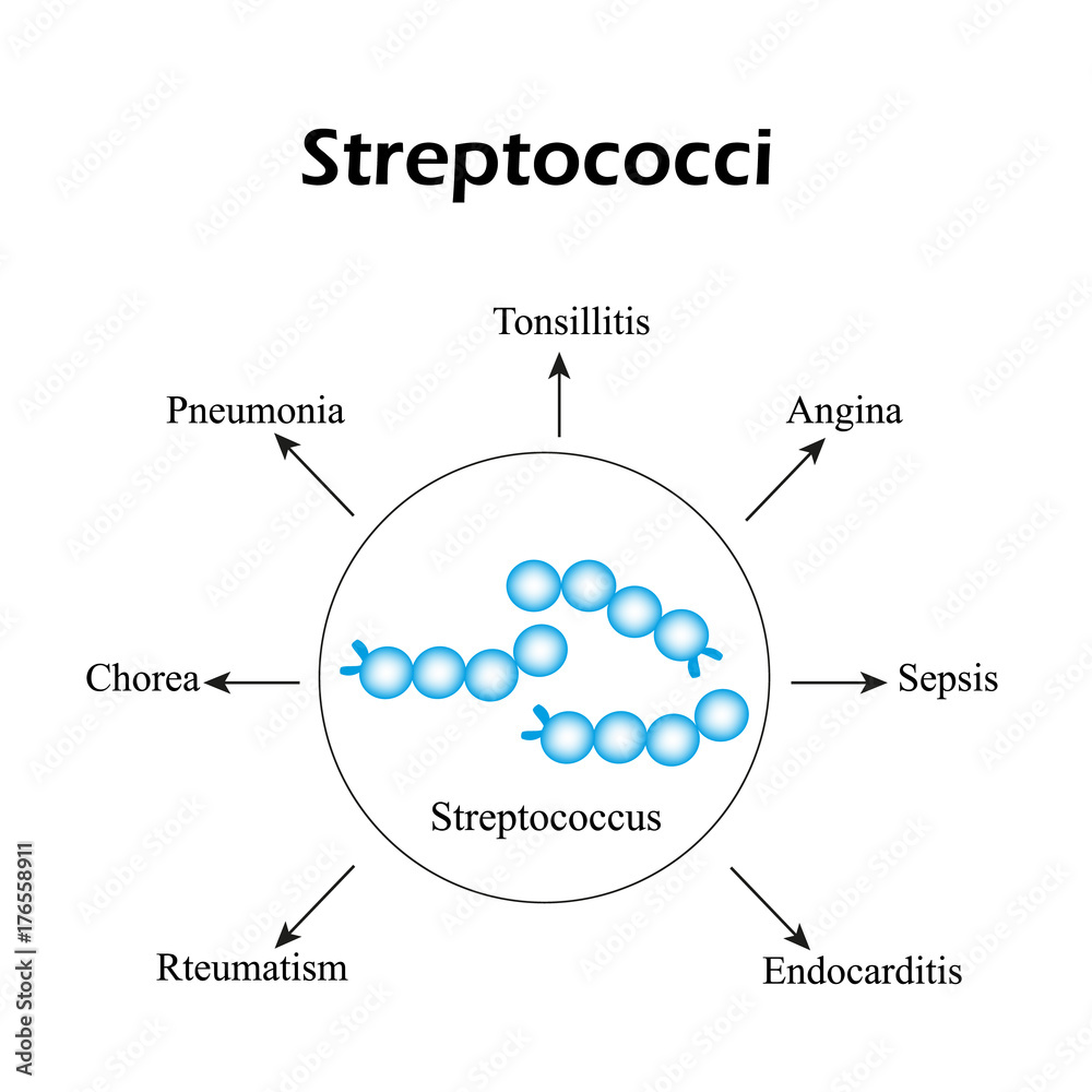 Streptococci. Streptococcal diseases. Infographics. Vector illustration ...
