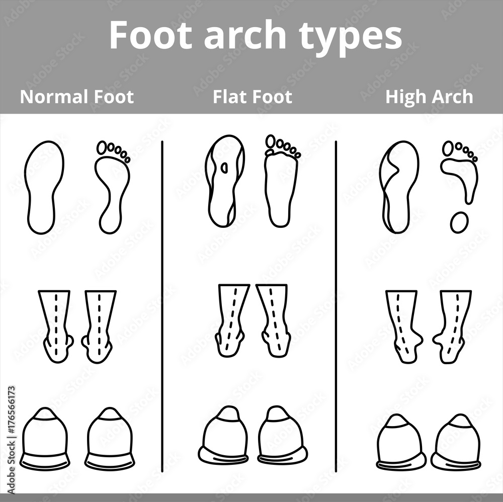 Foot arch types vector infographics. Set of flat foot, high arch Stock ...