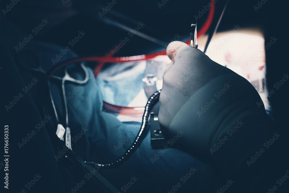 cannula and aorta is cross clamping using special flexible aorta clamp ...