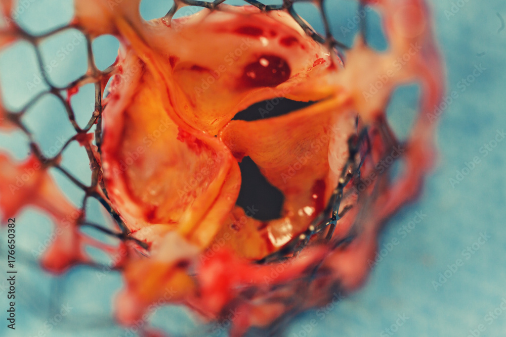 heart valve surgery for removing expandable transcatheter aortic valve ...